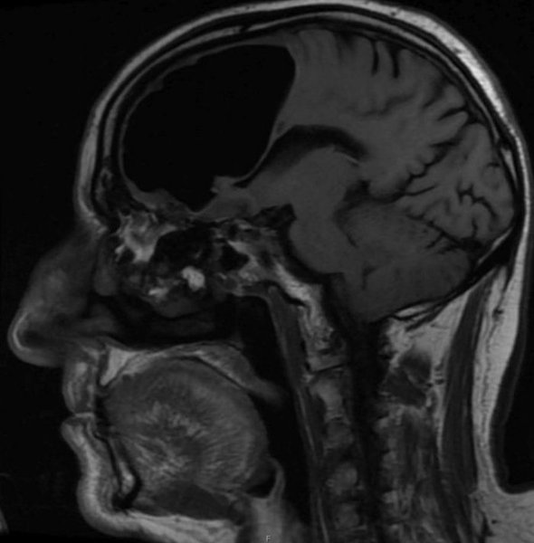 Boy Loses Big Chunk of Brain and He's Just Fine | RealClearScience