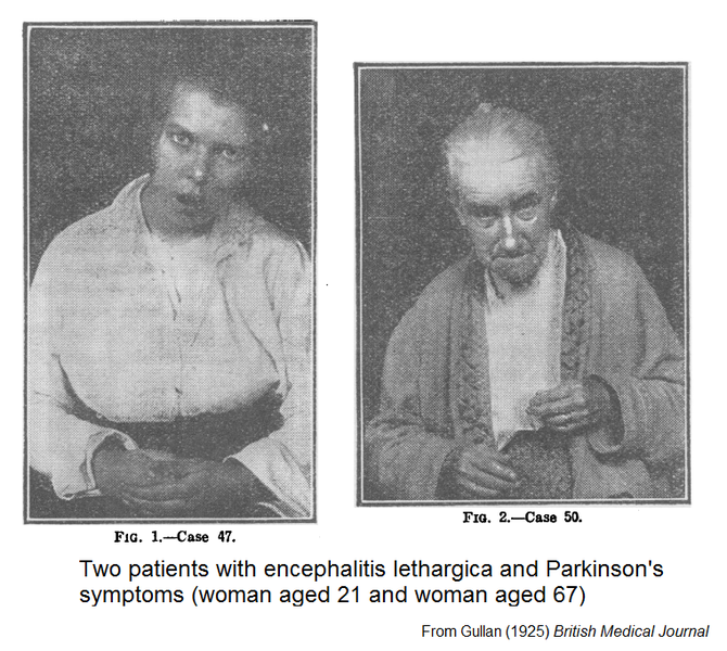 100 Years Later: The Lessons of Encephalitis Lethargica | RealClearScience