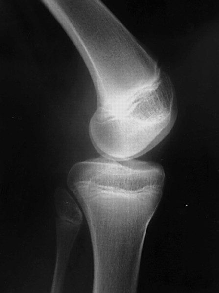 Six Rare Bone Disorders | RealClearScience