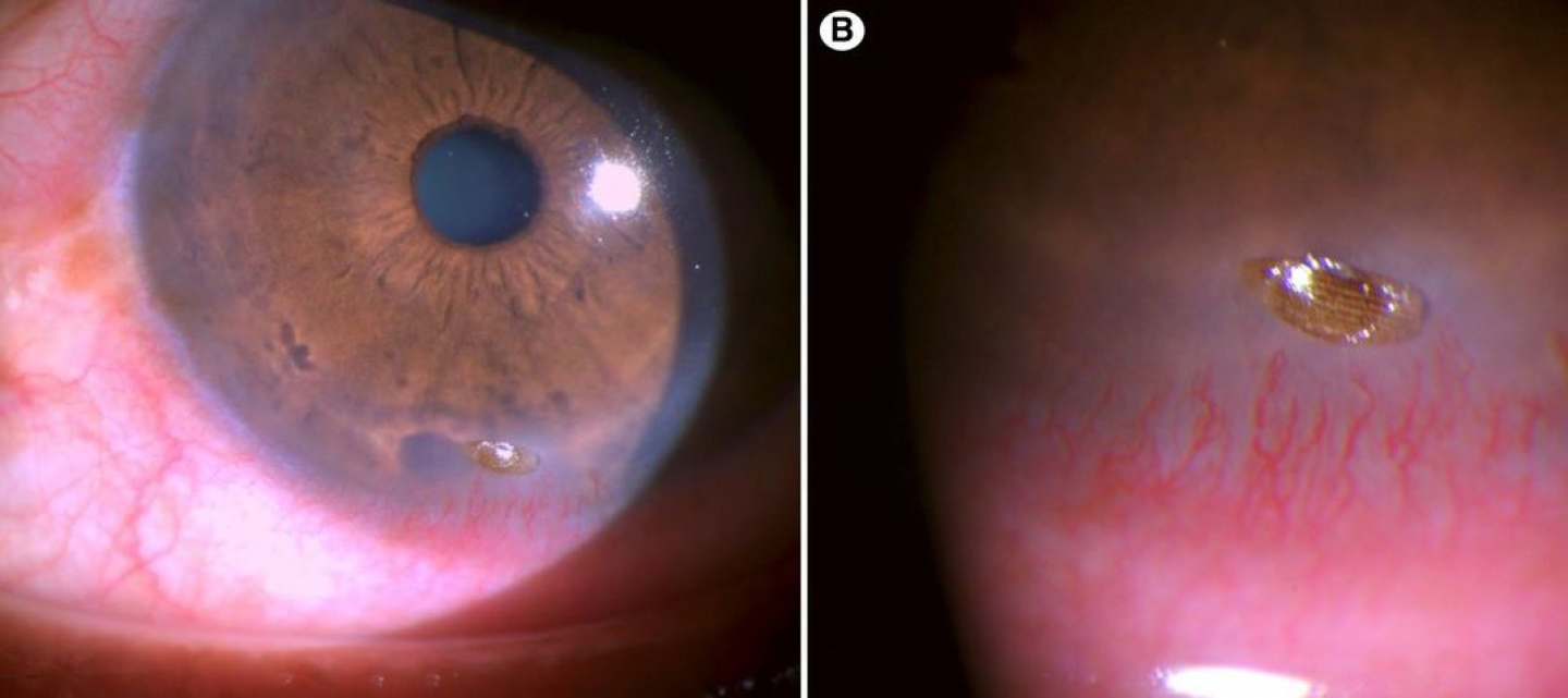 When Insect Parts Get Stuck in Your Eye | RealClearScience
