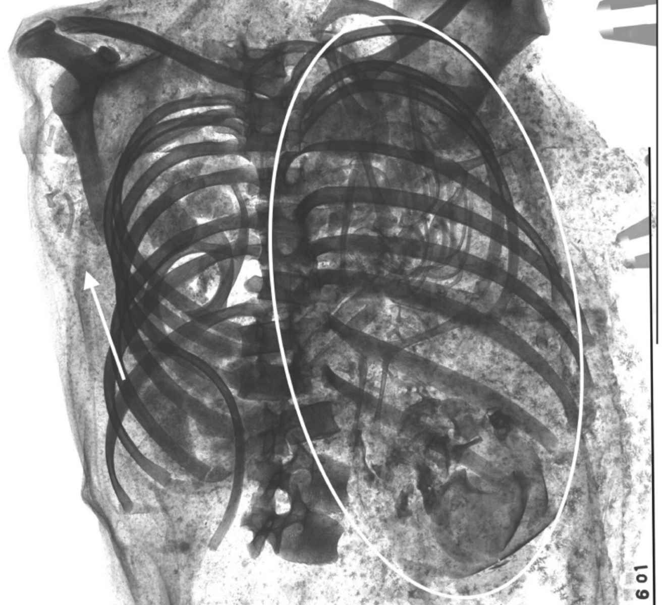 How Did a Fetus End Up Inside a Mummified Woman's Chest? | RealClearScience