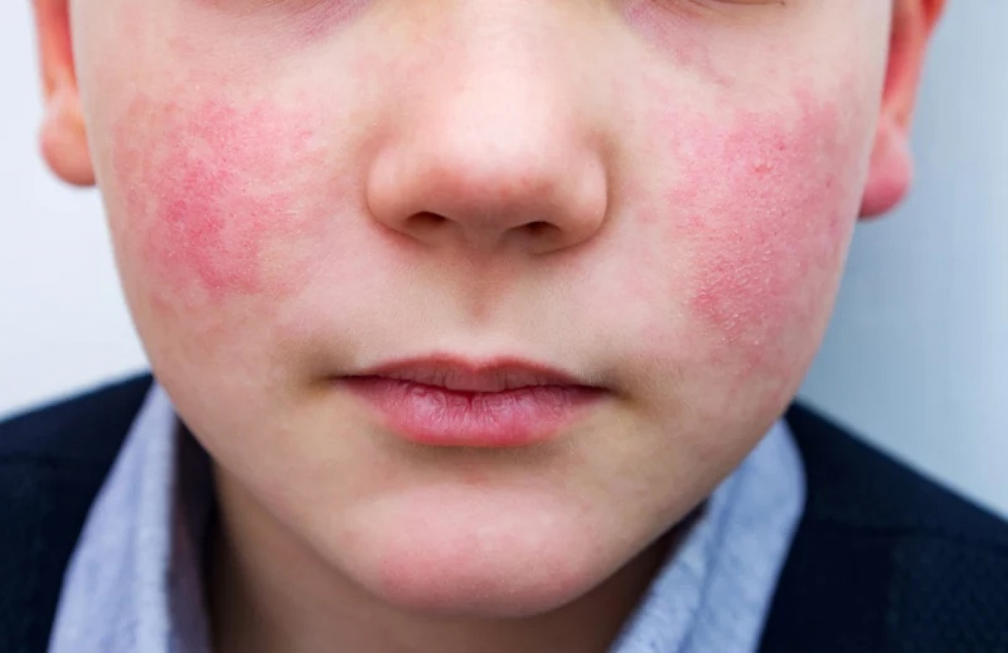 'Slapped Cheek' Virus Is Surging Across the U.S. | RealClearScience