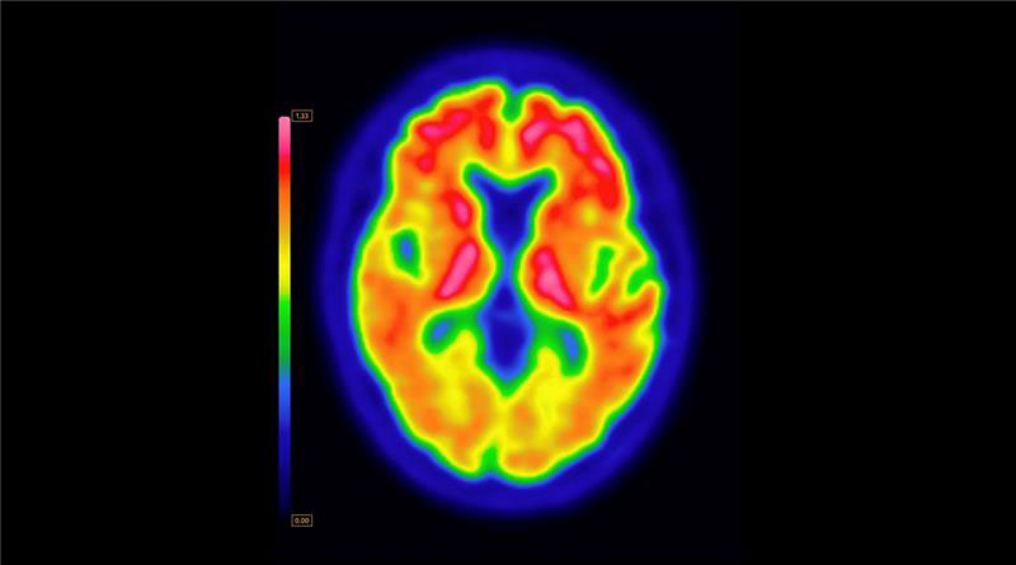 Brain Scan Reveals How Fast You're Aging | RealClearScience